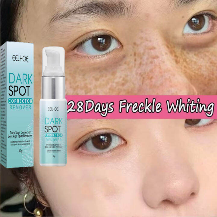 Ultimate Pekas Cream 3-5days goodbye sumpa kana ( for Freckles, Melasma ...