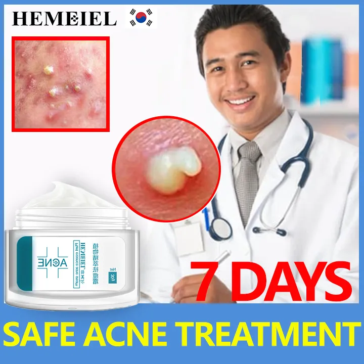 HEMEIEL Pimple Eraser Quick Fx/Pimples & Acne Remover Best Seller/Acne ...