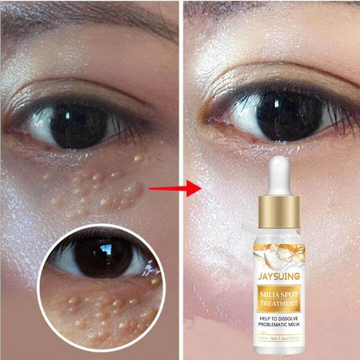 Jaysuing Milia 30ML Spot Treatment Eye Serum Milia Pore Treatment Serum ...