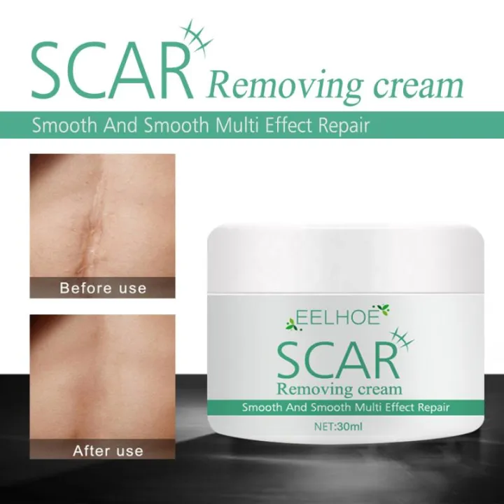 Plant Scar Repair Cream Acne Pit Scar Stretch Mark Remover สำหรับรอย ...