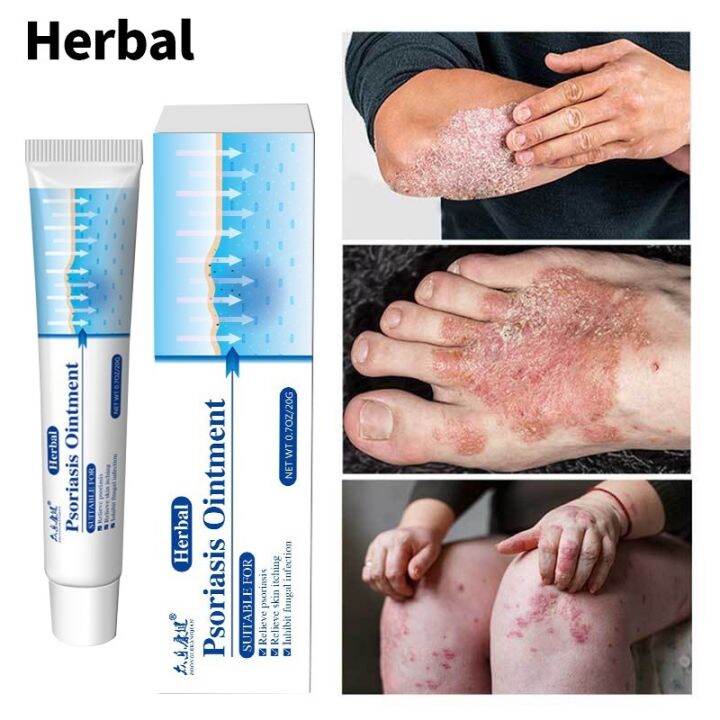 Psoriasis Antibacterial Cream Eczema Rash Treatment Dermatitis