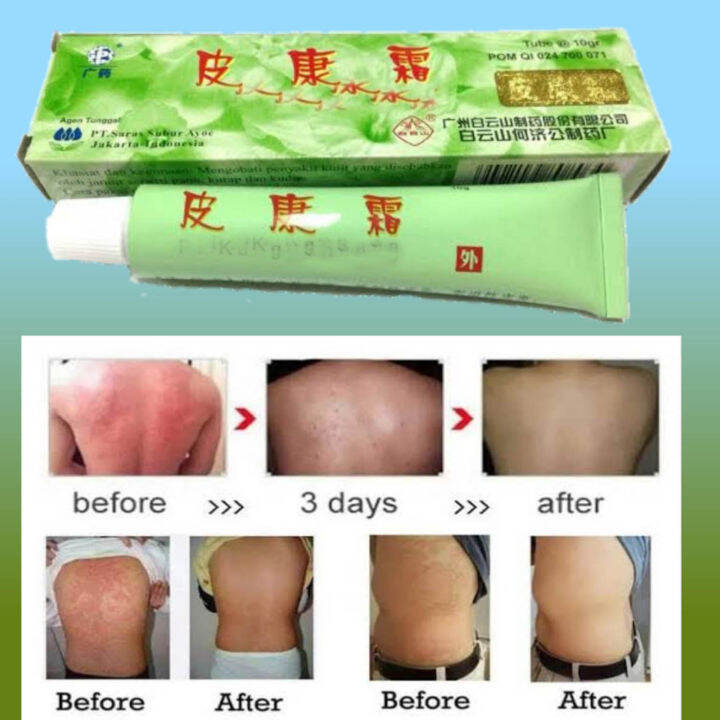 Salep Obat Kulit Gatal Anti Alergi-Salep Pikang suang asli-Pikangwang ... Salep Obat Kulit Gatal Anti Alergi-Salep Pikang suang asli-Pikangwang ...