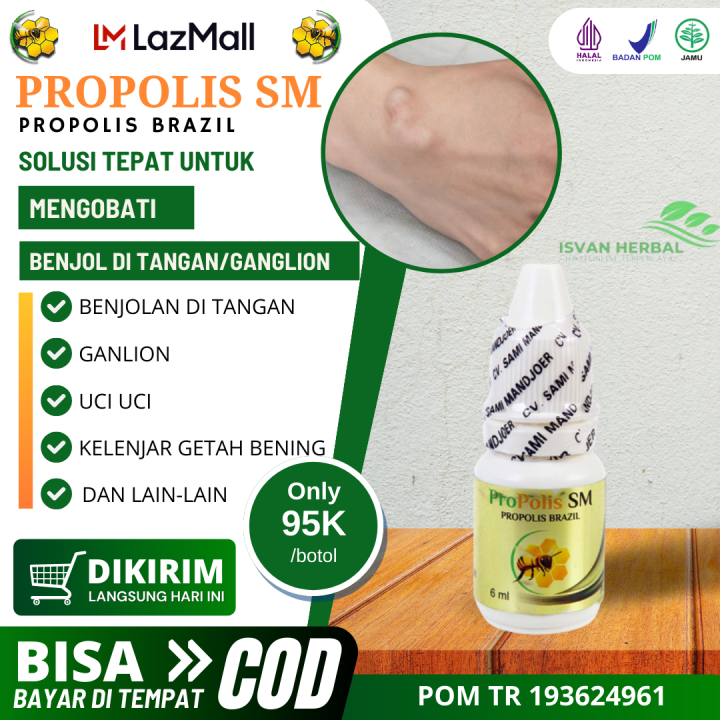 Obat benjolan di tangan, Obat kista ganglion, Obat lipoma, Obat oles ...