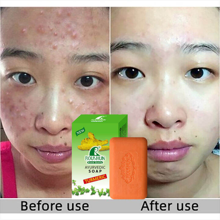 Turmeric Soap 75g Whitening Soap, Acne Treatment Soap, Pimple Treatment ...