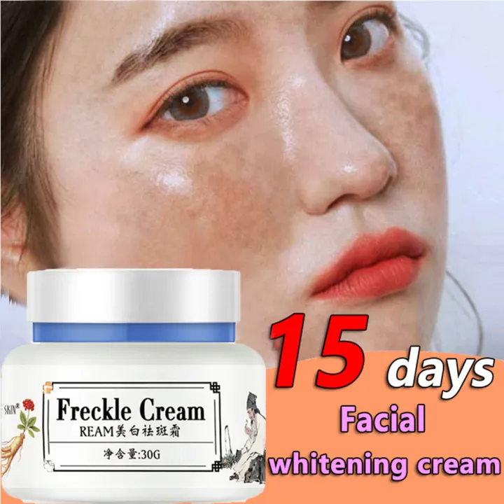 【Premium】100% Effective Melasma Removal Cream Melasma Dark Spot Remover ...