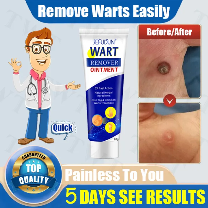 Effectively Remove Common Warts Flat Warts Filamentous Warts and Sharp ...