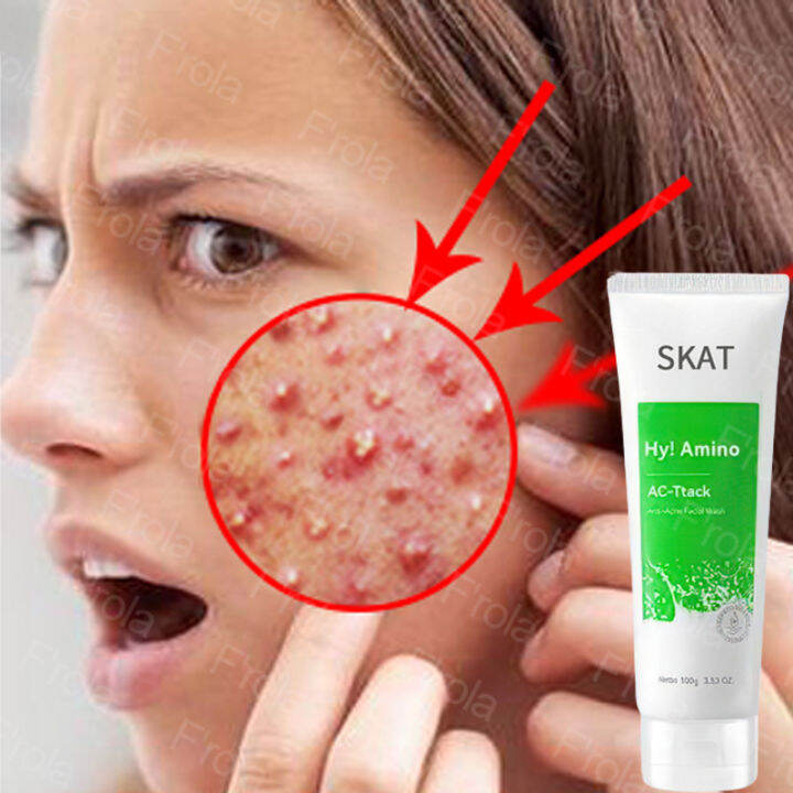 SKAT Hy!Amino Oil Control Facial Wash 100g | Anti - Acne Facial Wash ...