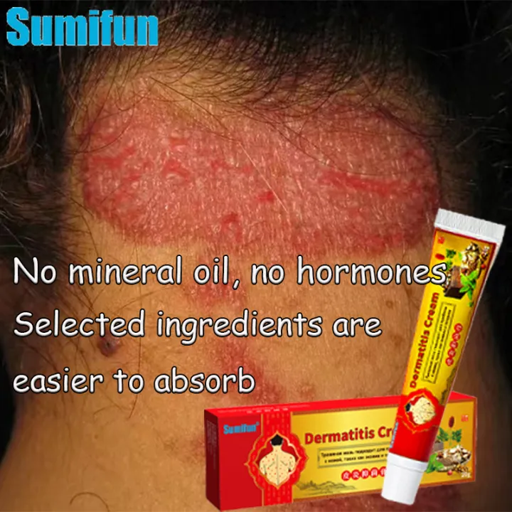 ointment for itchy skin and allergy sumilfun Dermatitis cream ...