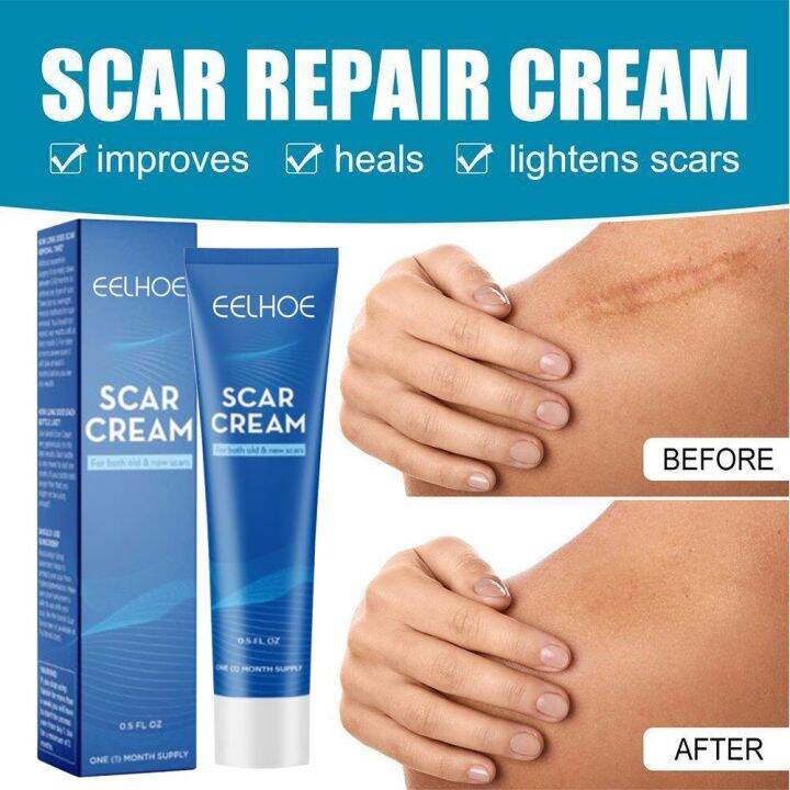Scar Remover Cream Scar Removal Cream Baby Scar Remover Dilute And ...