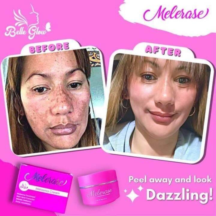 Hot qang34 Melarase Melasma Cream by Belle Glow Melasma and Pekas ...