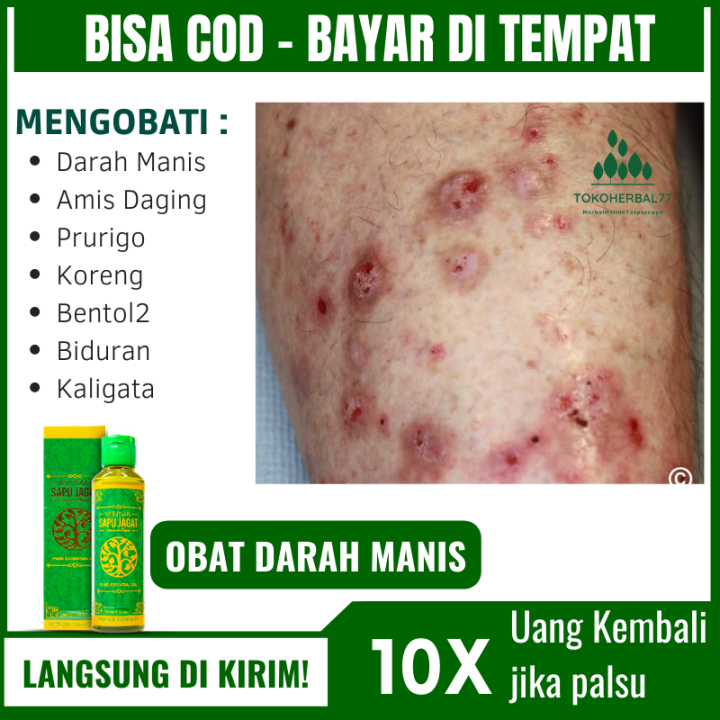 Obat Darah Manis, Obat Kulit Gatal, Obat Bekas Luka Darah Manis, Koreng ...