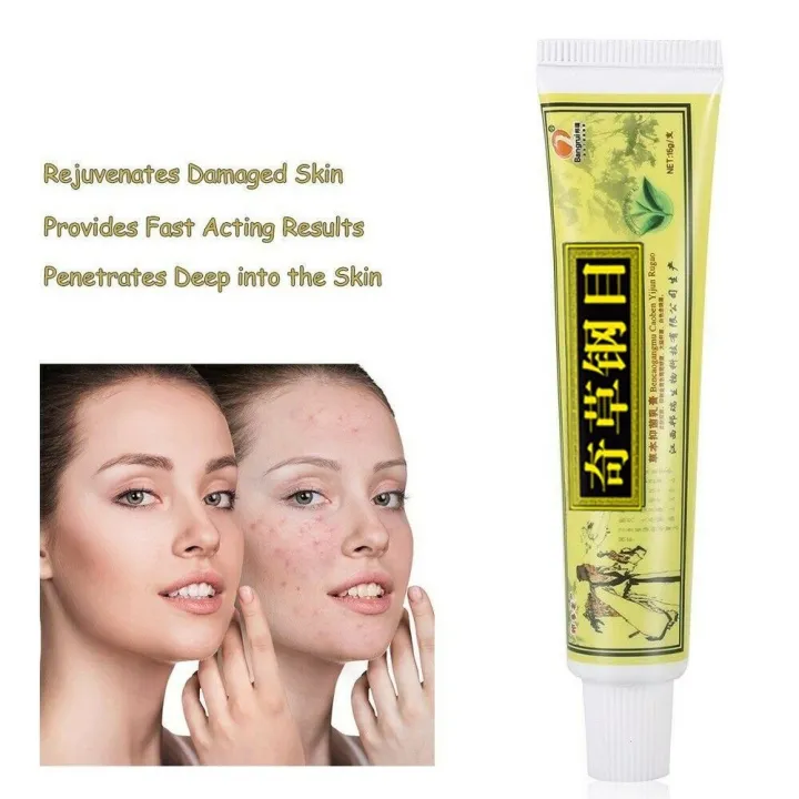 Original Natural Herbal Cream for Eczema Dermatitis Scabies Itching ...