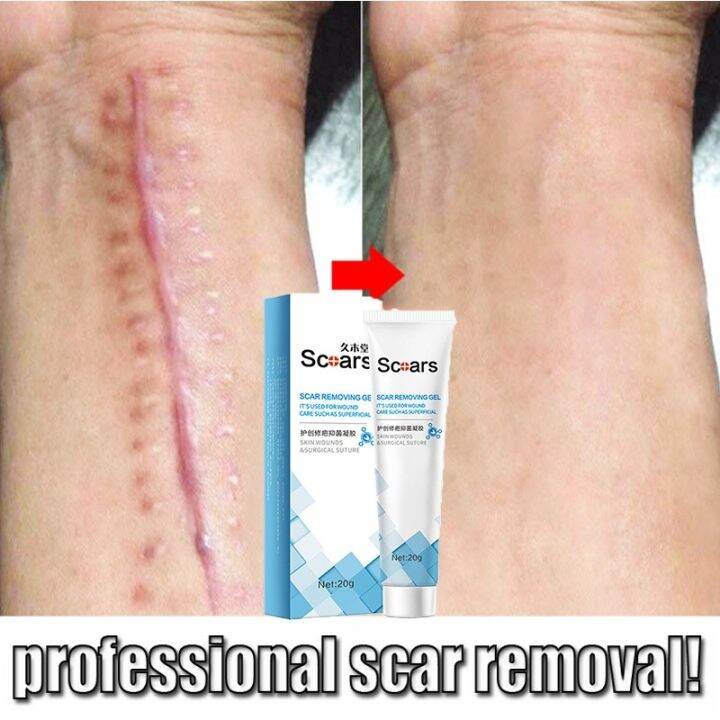 MerMer store Jiumutang Scars Remover, Removing Black Marks on Legs ...