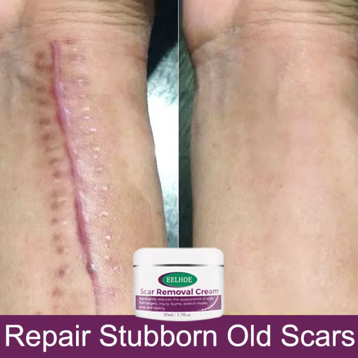 Scar Remover Peklat Remover Cream Original Peklat Remover For Old Scars ...