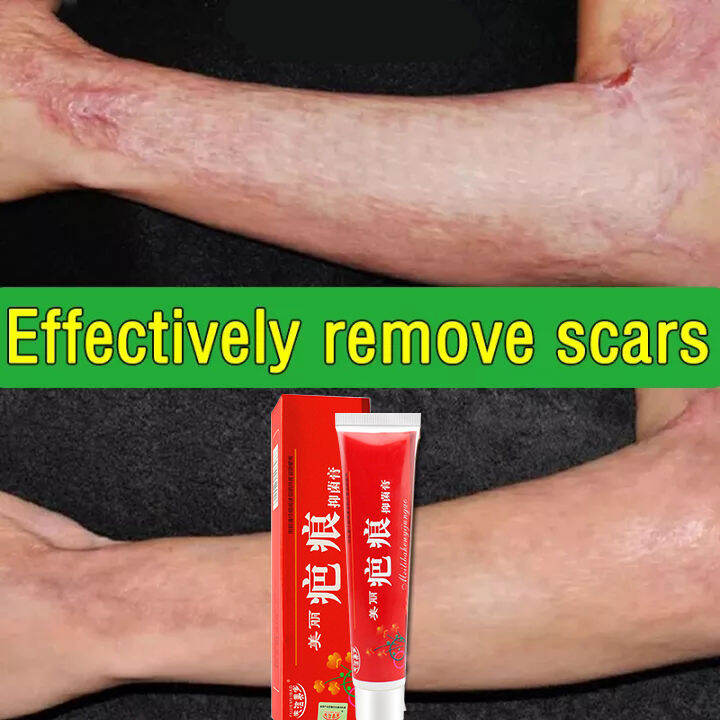 effective Scar Repair Cream Acne Marks Injury Scars Burns and Scalds ...