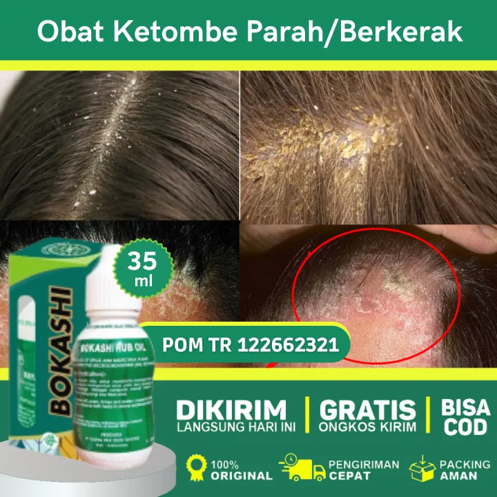 Obat Ketombe Kering - Ketombe Berkerak - Ketombe Akut - Ketombe Parah, Menghilangkan Gatal Di ...