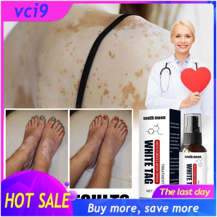 Hot 】SouthMoon vitiligo treatment vitiligo spray white spot spray ...
