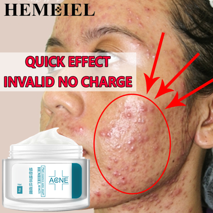 HEMEIEL Pimple Marks Remover/Sos Clindamycin/Acne Treatment Set | Lazada PH