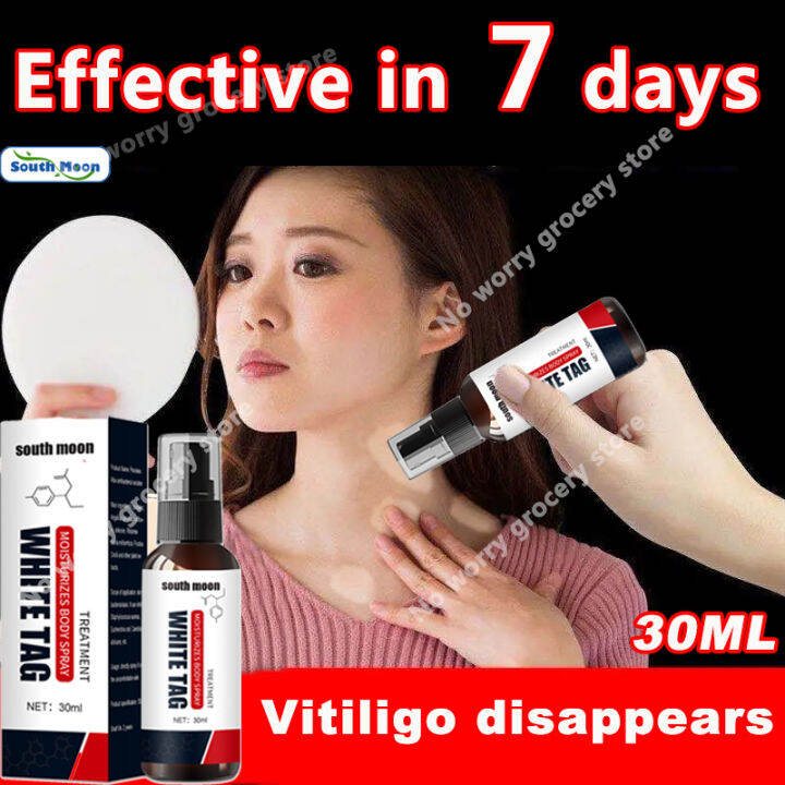 South Moon vitiligo remover 30ML vitiligo treatment cream vitiligo spot ... South Moon vitiligo remover 30ML vitiligo treatment cream vitiligo spot ...
