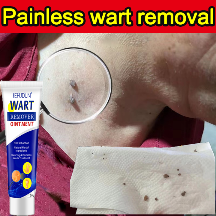 💖Safe Painless💖Warts Remover Original Cream Warts Magic Remover Wart ...