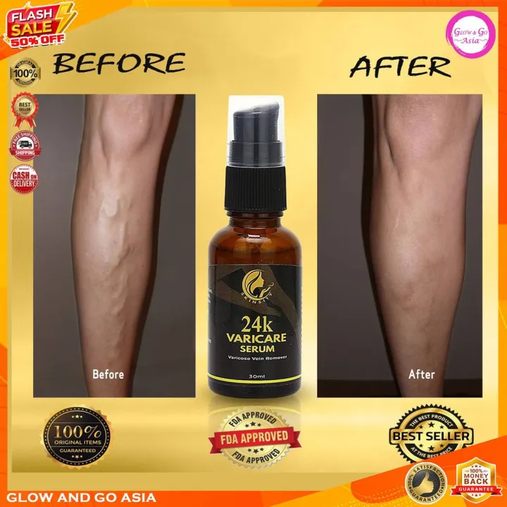 Original & Best Selling Skinsity 24k Varicose Vein Remover Varicare ...