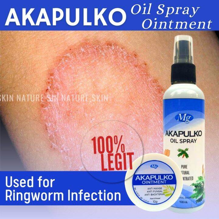 High Quality Product BUNDLE SET Akapulko Oil Spray and Ointment Treat ...