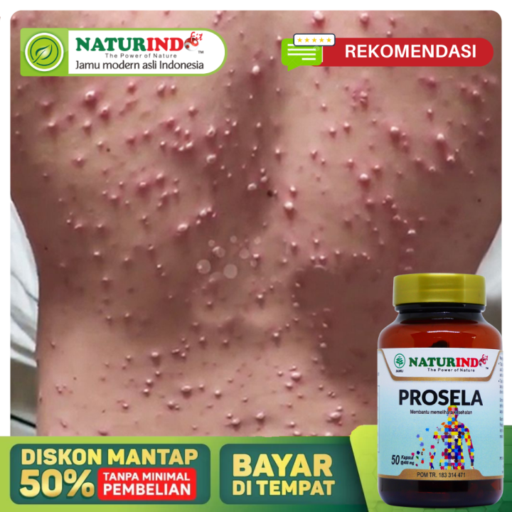 Obat Cacar Air Paling Ampuh Varisella zoster Bintik Berair Penghilang ...