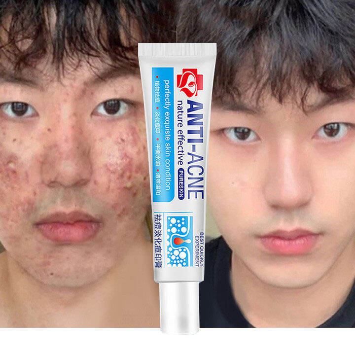 【Spot goods】Acne cream Whitening cream 25g Fade acne marks Acne add ...