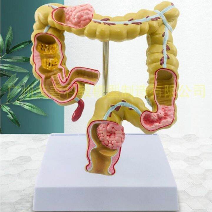 E. lesions pathologic anatomy model bowel disease human colon lesions ...