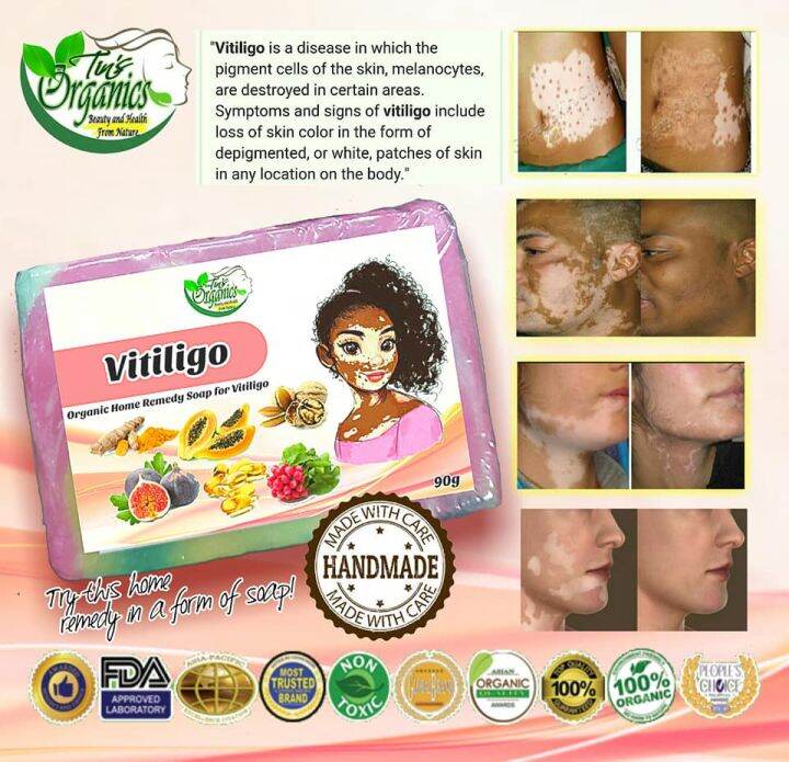 Vitiligo Organic Herbal Lotion | Lazada PH
