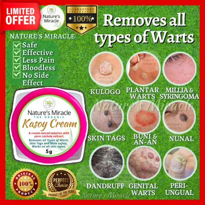 Strong Kasoy Cream Warts Kulugo Remover Mole Remover Skin Tag Millia ...