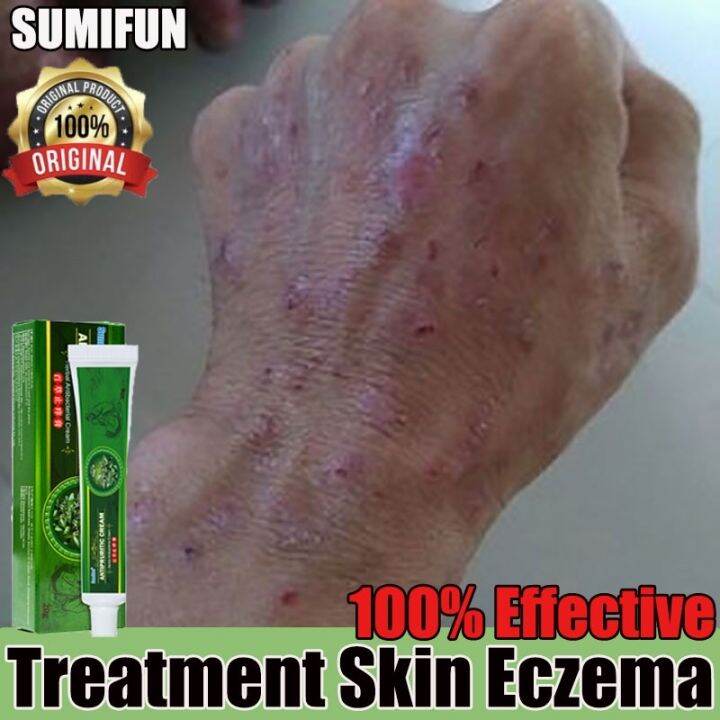 Bghjuya Sumifun Psoriasis Eczema Ointment Cream 20g Effective Treatment