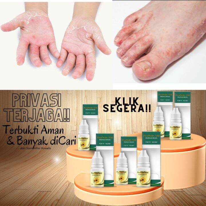 Obat Jari Tangan Kering, Jari Kaki Pecah dan Kering, Obat Telapak ...
