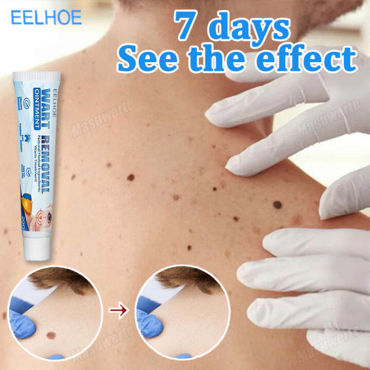 100% ORIGINAL EFFECTIVE Ointment Original Warts Cream Corn Plantar Wart ...