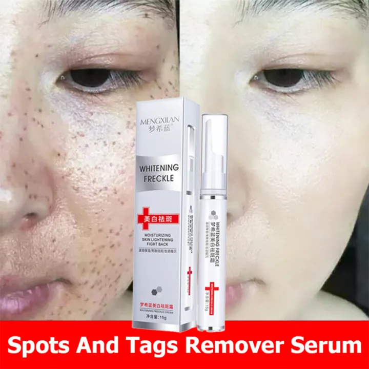 Whitening Freckle Cream Dark Spot Corrector Cream Powerful Removing Chloasma Melanin Dark Spots ...