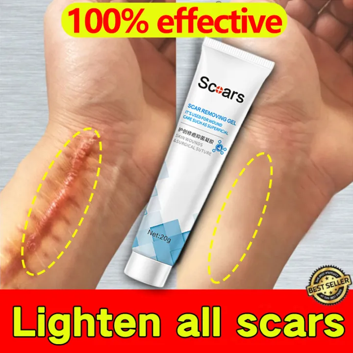 100% Effective Scar Removal Cream Scar Remover Gel All Scars can be ...