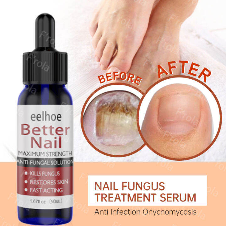 [Universal For Hands And Feet] Nail Care Liquid 50ml Fungisol ...