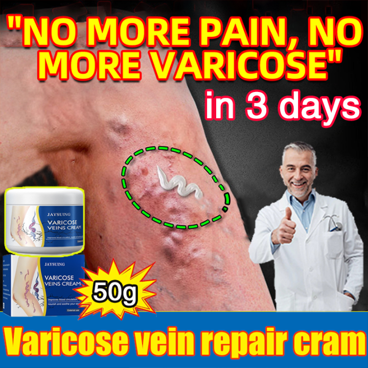 JAYSUING Varicose Vein Cream 50g Varicose Vein Ointment Relieve ...