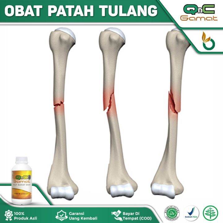 Obat Patah Tulang Akibat Jatuh Kecelakaan, Tulang Patah, Tulang Retak ...