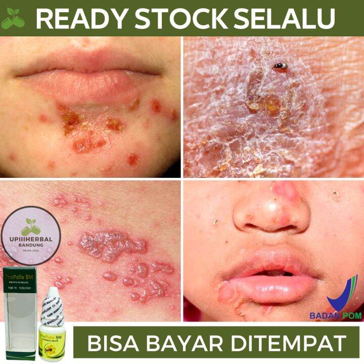 Obat Impetigo, Obat Untuk Penyakit Impetigo, Obat Infeksi Kulit Impetigo, Obat Pencegahan ...
