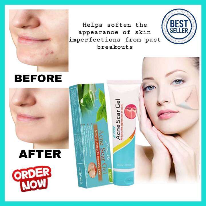 BEST SELLING!!! Acne Scar Gel/Remove Scar Acne Fade Stretch Marks ...