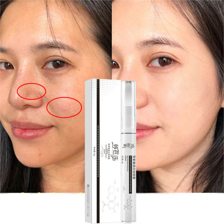 Nicotinamide Dark Spot Corrector Cream Whitening Freckle Cream Powerful Removing Melasma Melanin ...
