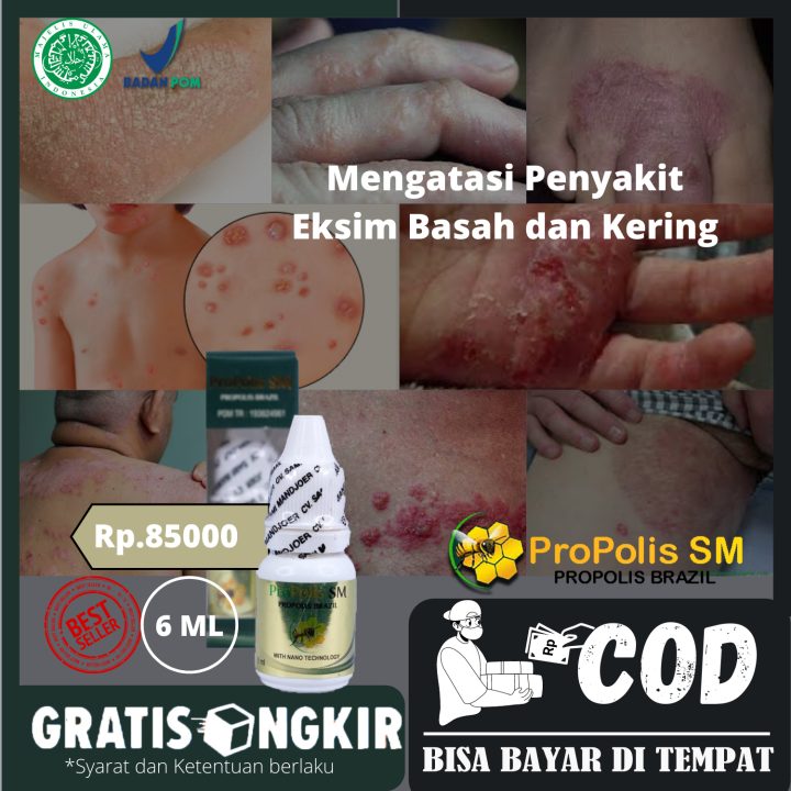 Obat Oles Kulit Gatal Kurap Kudis Koreng, Budug Eksim Luka Garuk Infeksi Bakteri Kista Hernia ...