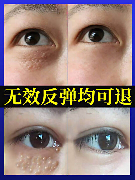 Special ointment for removing fat particles, syringoma, eye artifact ...