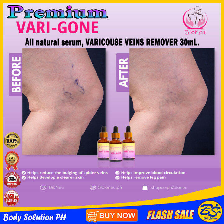 PREMIUM VARI-GONE VARICOSE VEINS ALL NATURAL SERUM VARICOSE VEINS ...