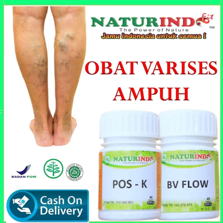 Obat Varises Farises Parises Varises Kaki Varises Betis Pembengkakan ...