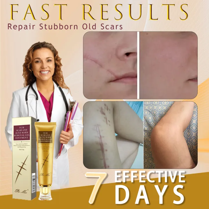 scar removal cream scar remover for old scar on leg fix scar removal ...