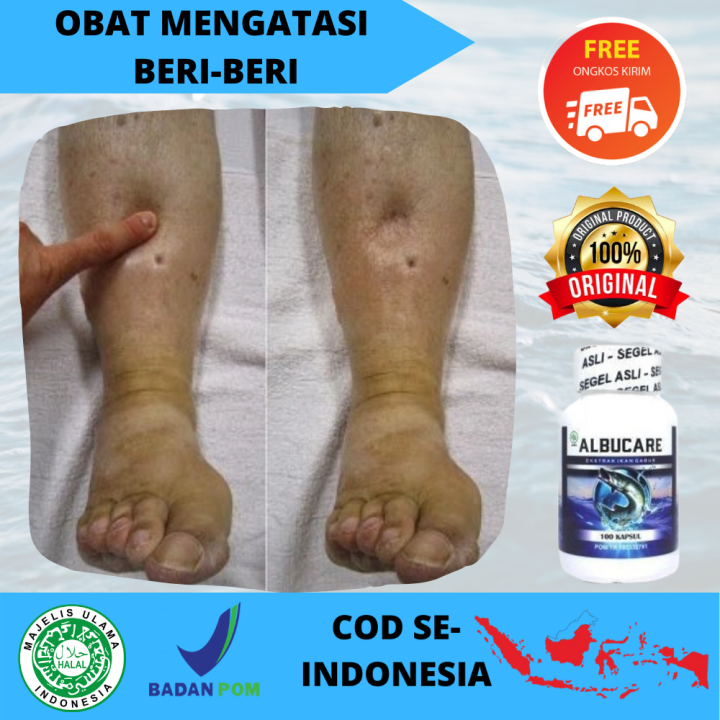 Obat Beri Beri, Herbal Untuk Mengobati Penyakit Beri2 Pada Kaki Sebelah ...