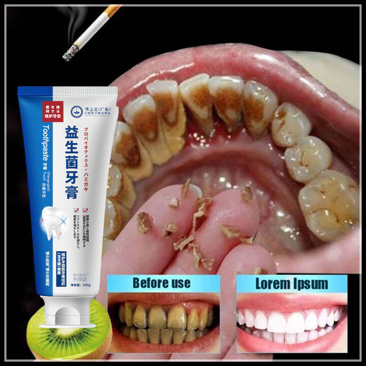 Teeth Whitening Toothpaste Remove Tartar Yellow Teeth Removal Smoking ...