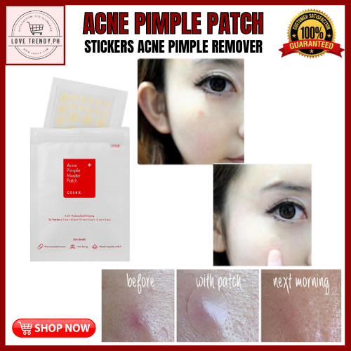 Acne Pimple Patch Stickers Acne Pimple Remover Tool Absorb Pus And Oil ...